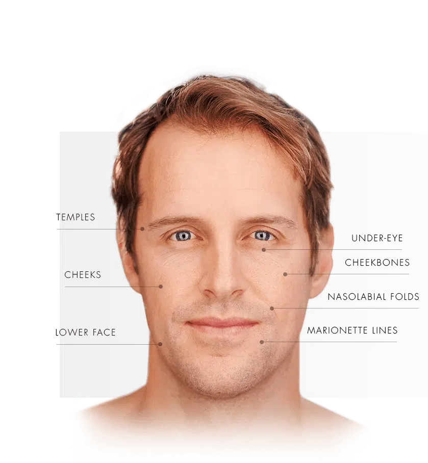 dermal-filler-mywellness